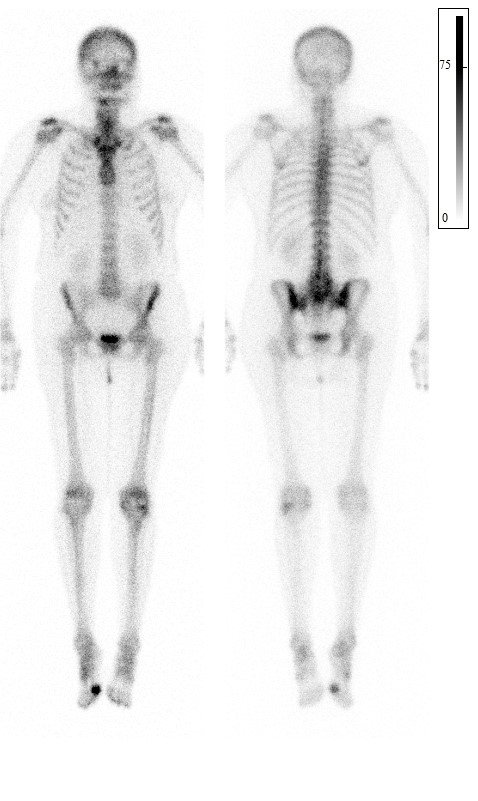 Nuklearmedizinische Untersuchung – Szintigraphie – Radiologisches ...