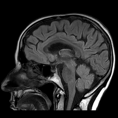 Mrt Kopfschmerzen Erfahrungen , Cluster-Kopfschmerzen – JMZC